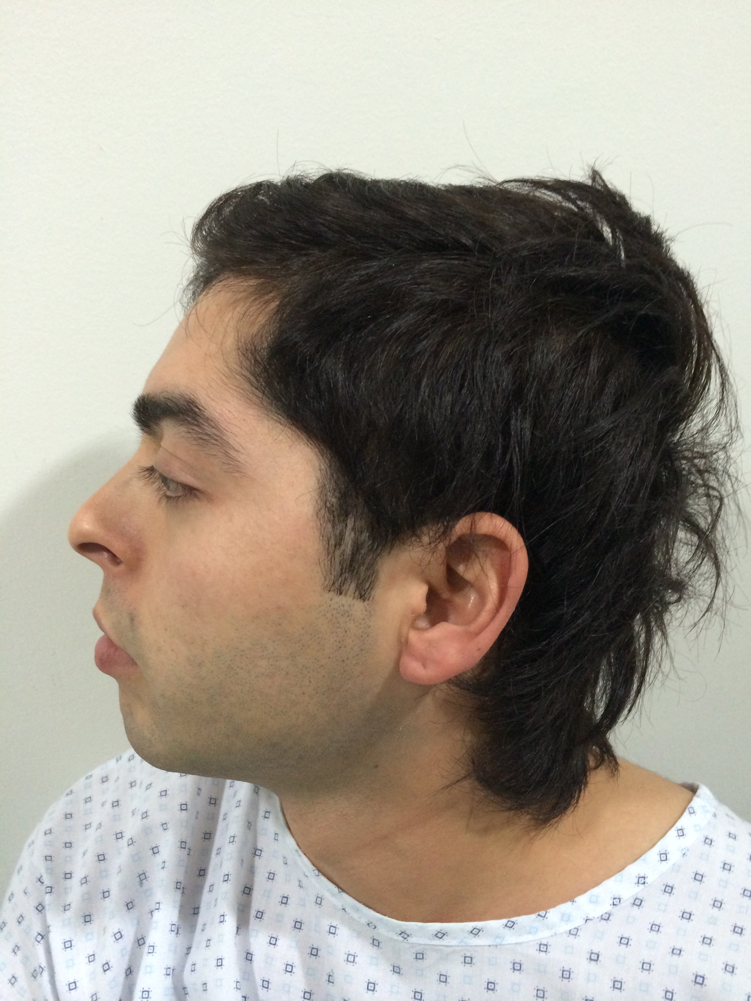 Implante de mentón | Dr. Diego Polanco